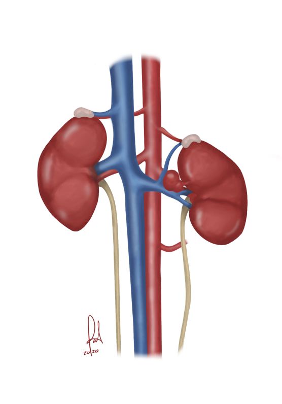 Kidney Auto Transplant 1